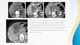 MANAGEMENT OF ACUTE CHOLECYSTITS.pptx