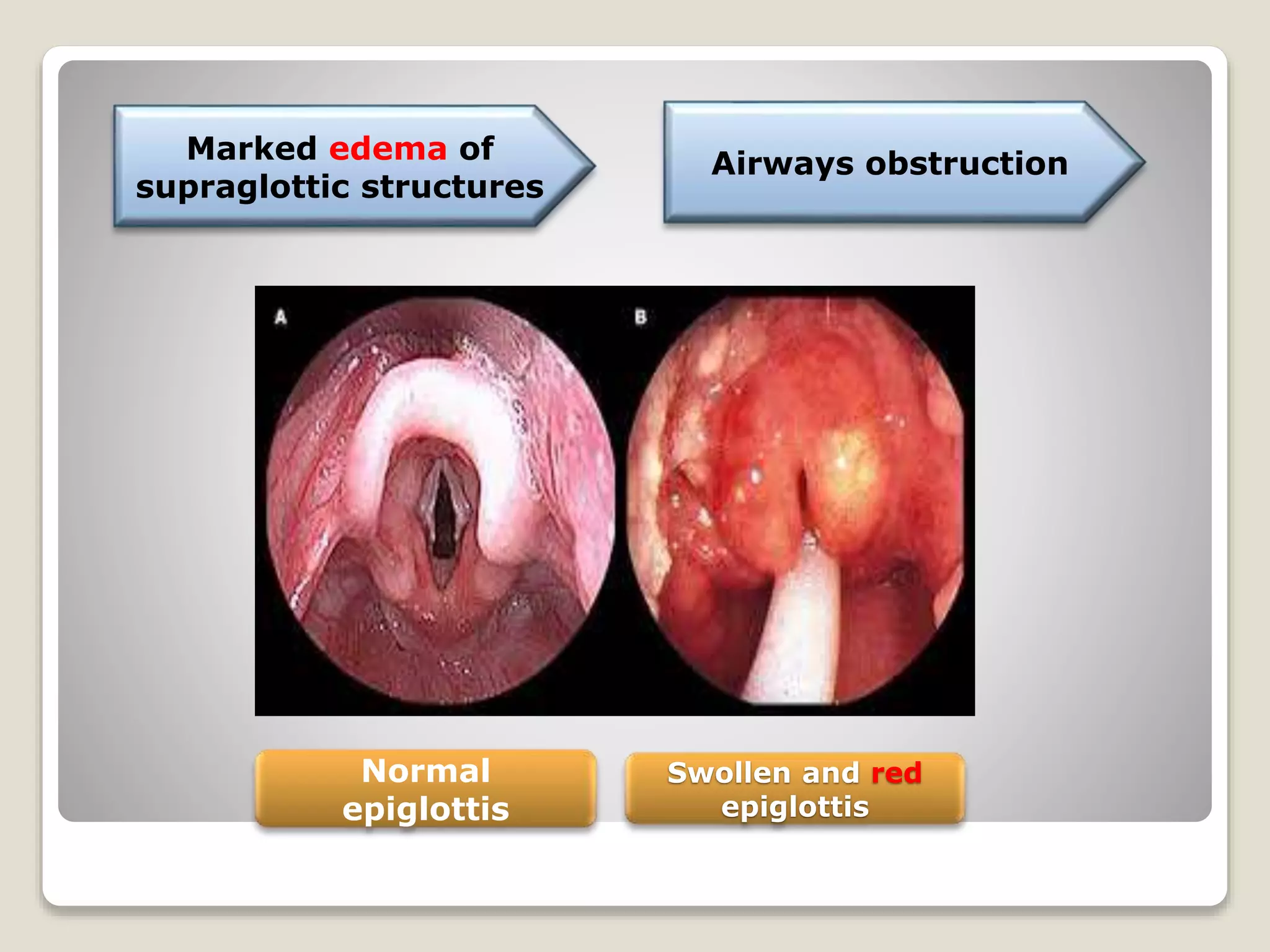 Management of acute epiglottitis | PPTX