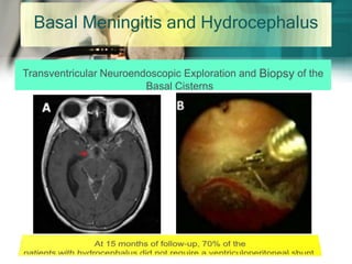 Management of acute hydrocephalus | PPTX