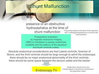 Management of acute hydrocephalus | PPTX