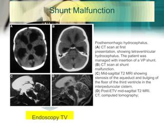 Management of acute hydrocephalus | PPTX