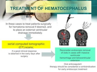 Management of acute hydrocephalus | PPTX