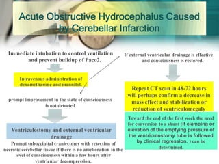 Management of acute hydrocephalus | PPTX | Brain and Nervous System Disorders | Diseases and ...