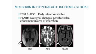 Management of acute ischemic stroke including tia [autosaved] | PPTX
