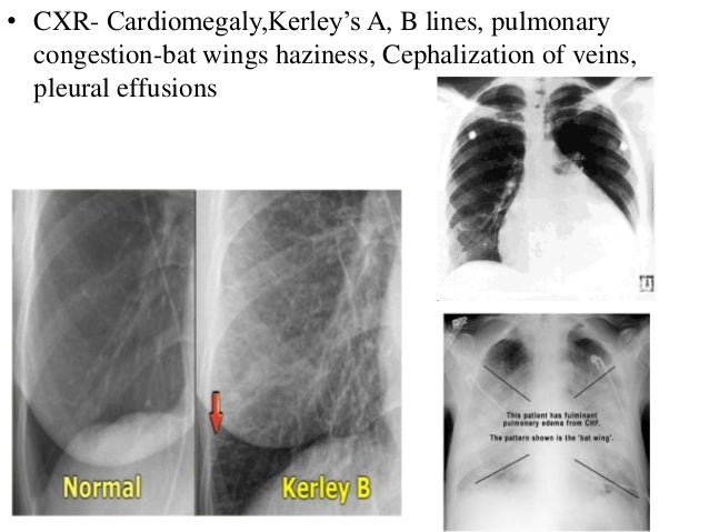 Management of acute lvf