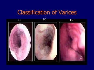 Management of acute upper GI hemorrhage | PPTX