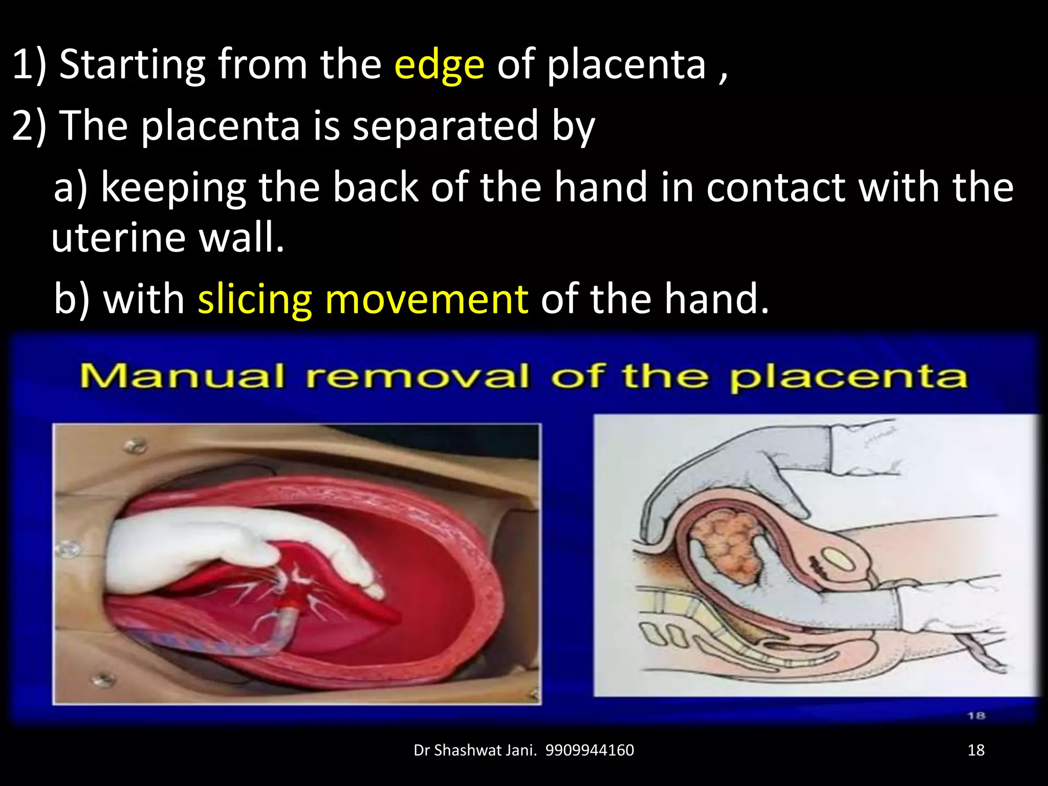MANAGEMENT OF ACUTE UTERINE INVERSION BY DR SHASHWAT JANI | PPT