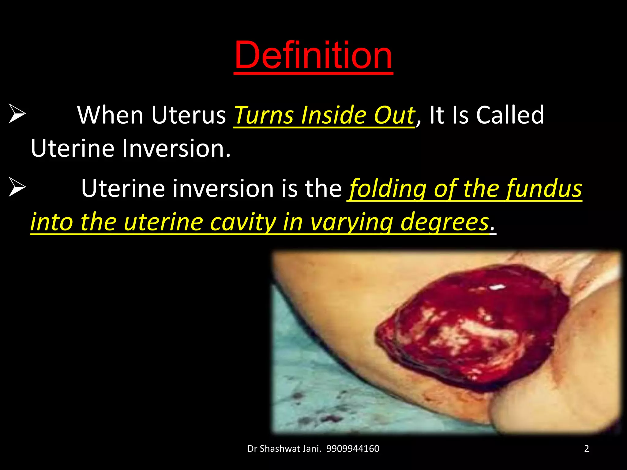 MANAGEMENT OF ACUTE UTERINE INVERSION BY DR SHASHWAT JANI | PPTX