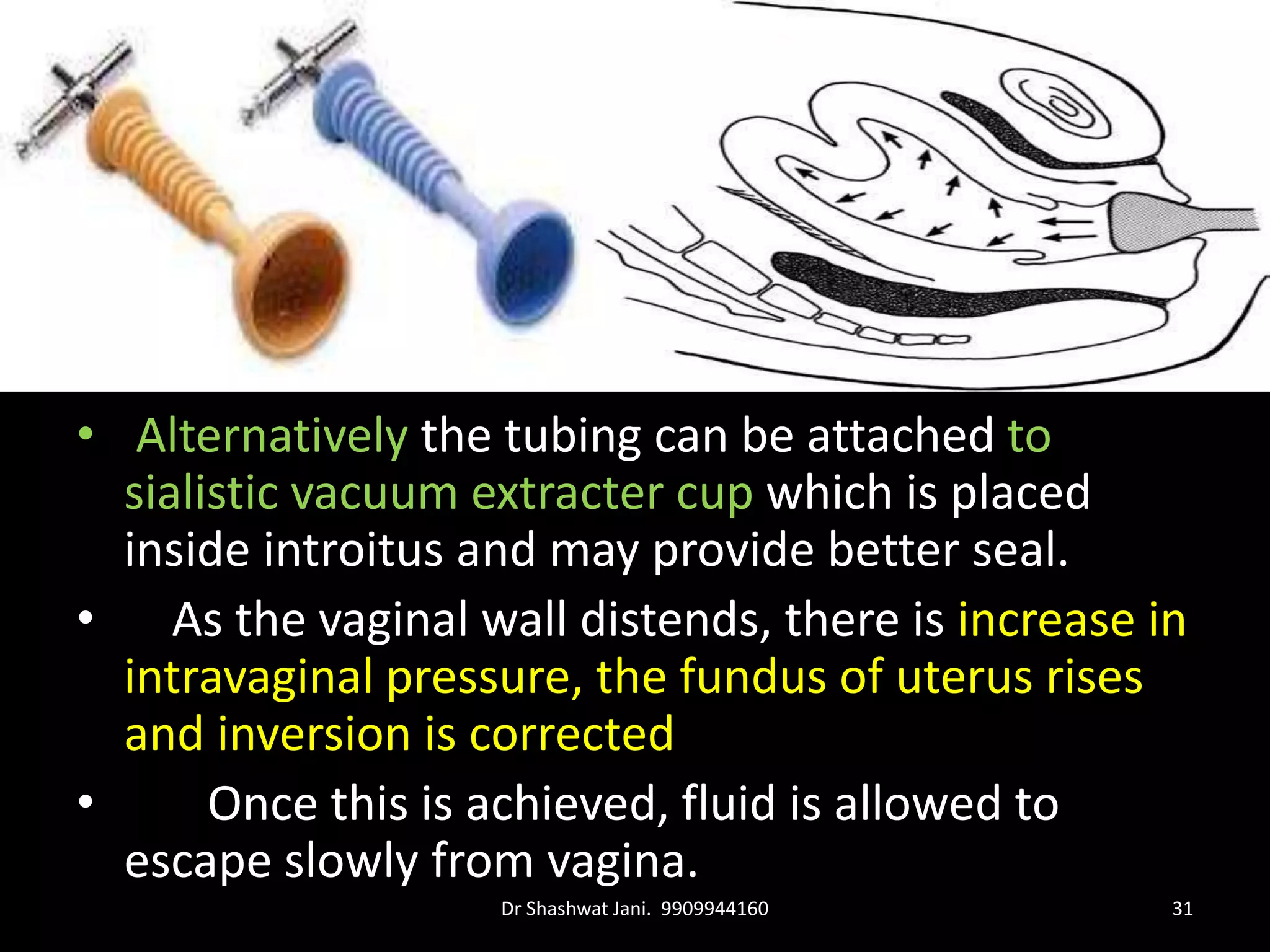 MANAGEMENT OF ACUTE UTERINE INVERSION BY DR SHASHWAT JANI | PPTX