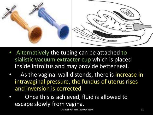 MANAGEMENT OF ACUTE UTERINE INVERSION BY DR SHASHWAT JANI