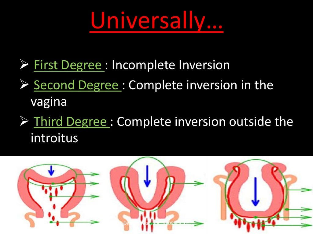 MANAGEMENT OF ACUTE UTERINE INVERSION BY DR SHASHWAT JANI