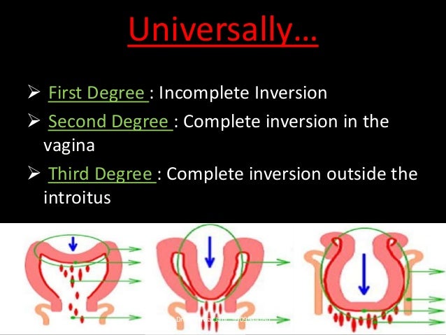 MANAGEMENT OF ACUTE UTERINE INVERSION BY DR SHASHWAT JANI