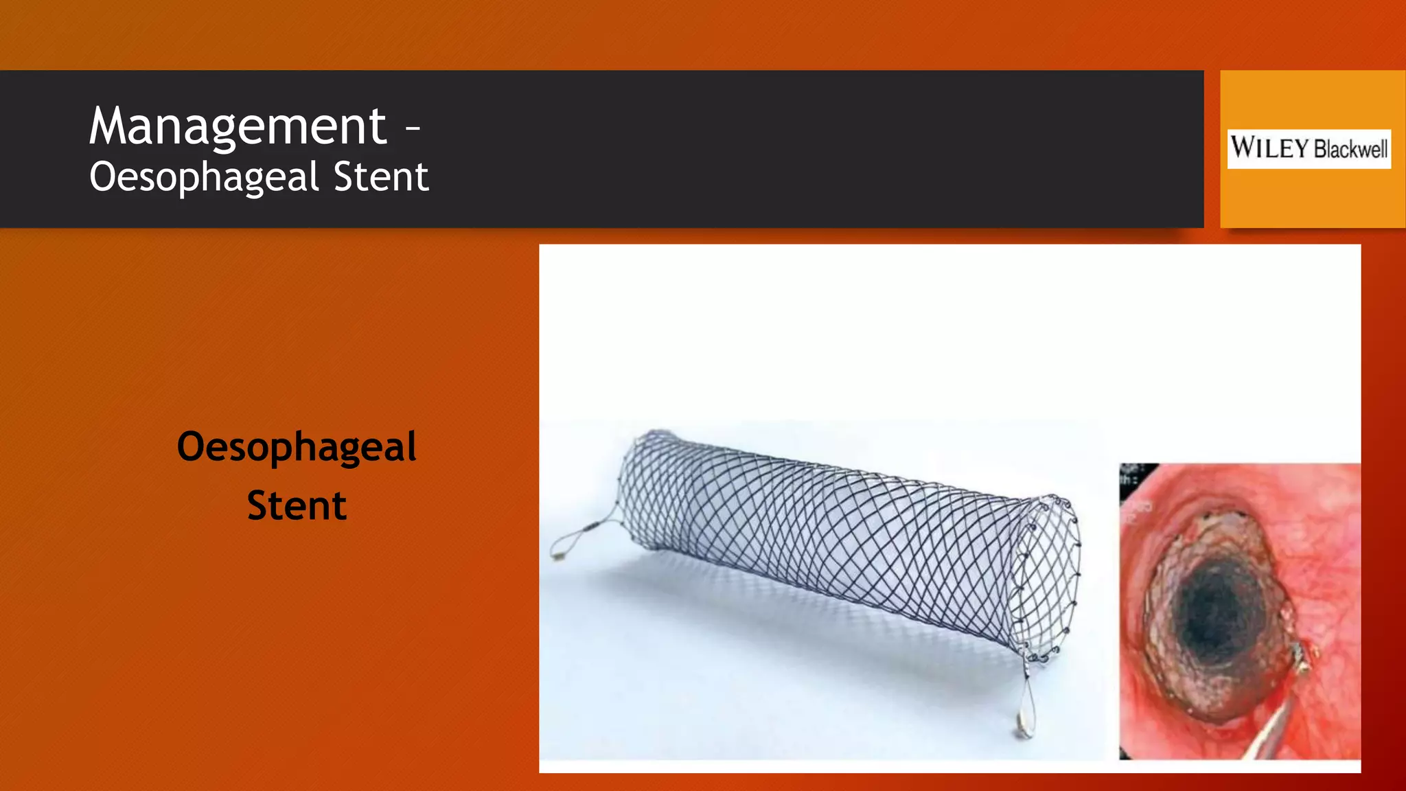 Management of Acute Variceal Bleeding | PPTX