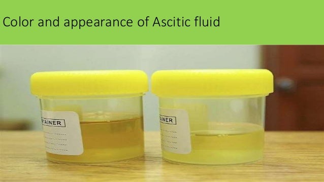 Management of adult patients with ascites due to