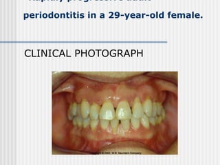 Management of aggressive periodontitis | PPT