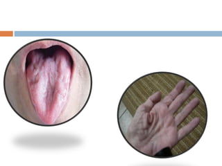 Management of ALS.pptx