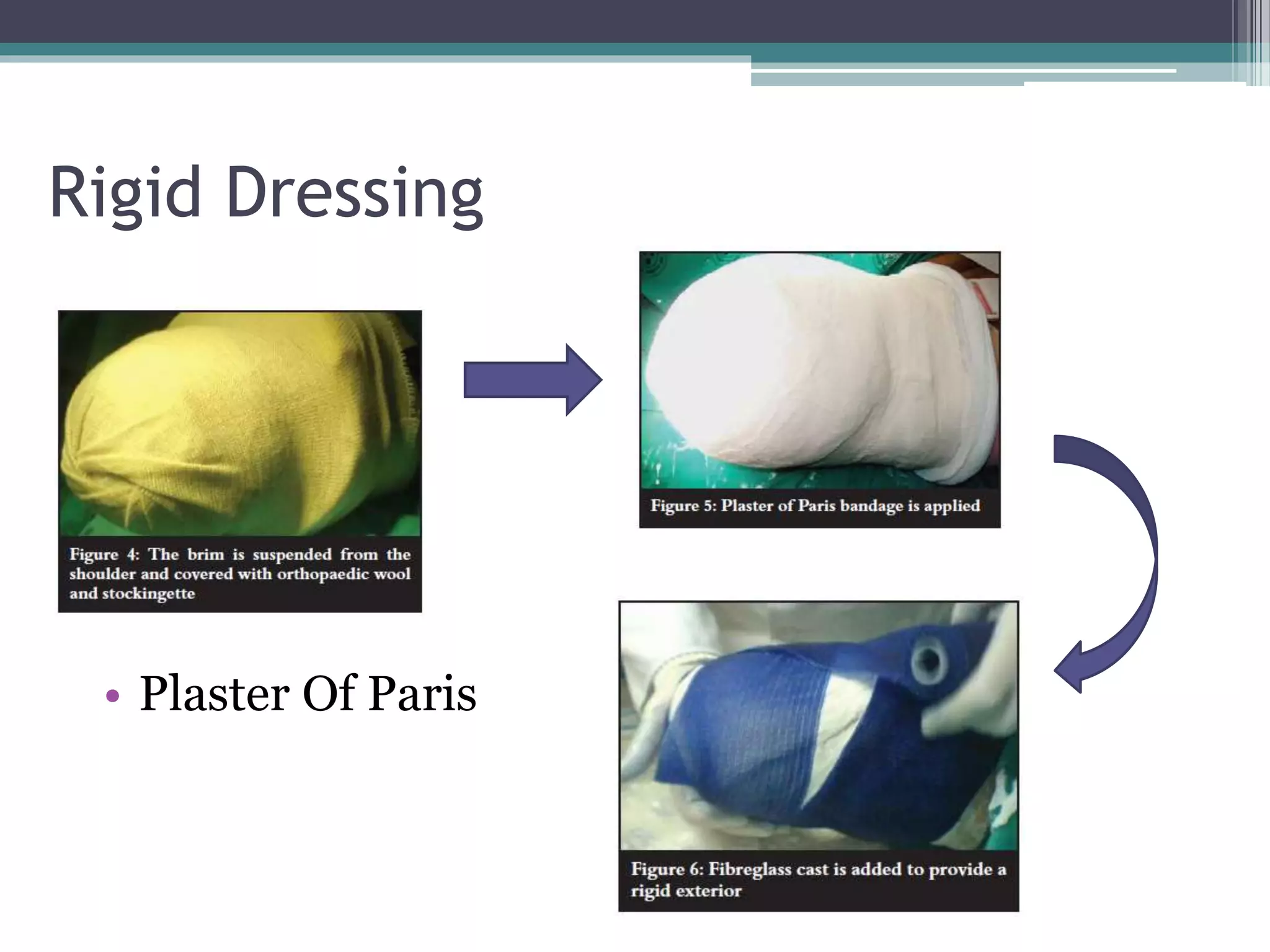 Management Of Amputation Stump.pptx
