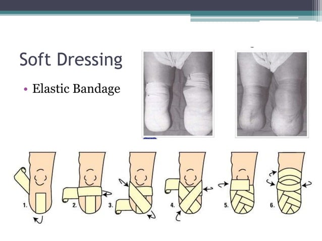Management Of Amputation Stump.pptx