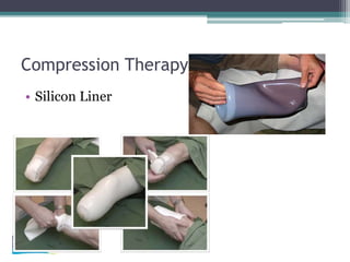 Management Of Amputation Stump.pptx