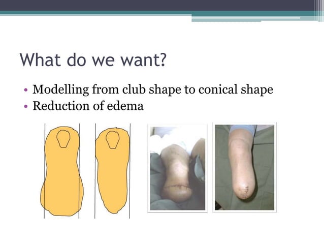 Management Of Amputation Stump.pptx