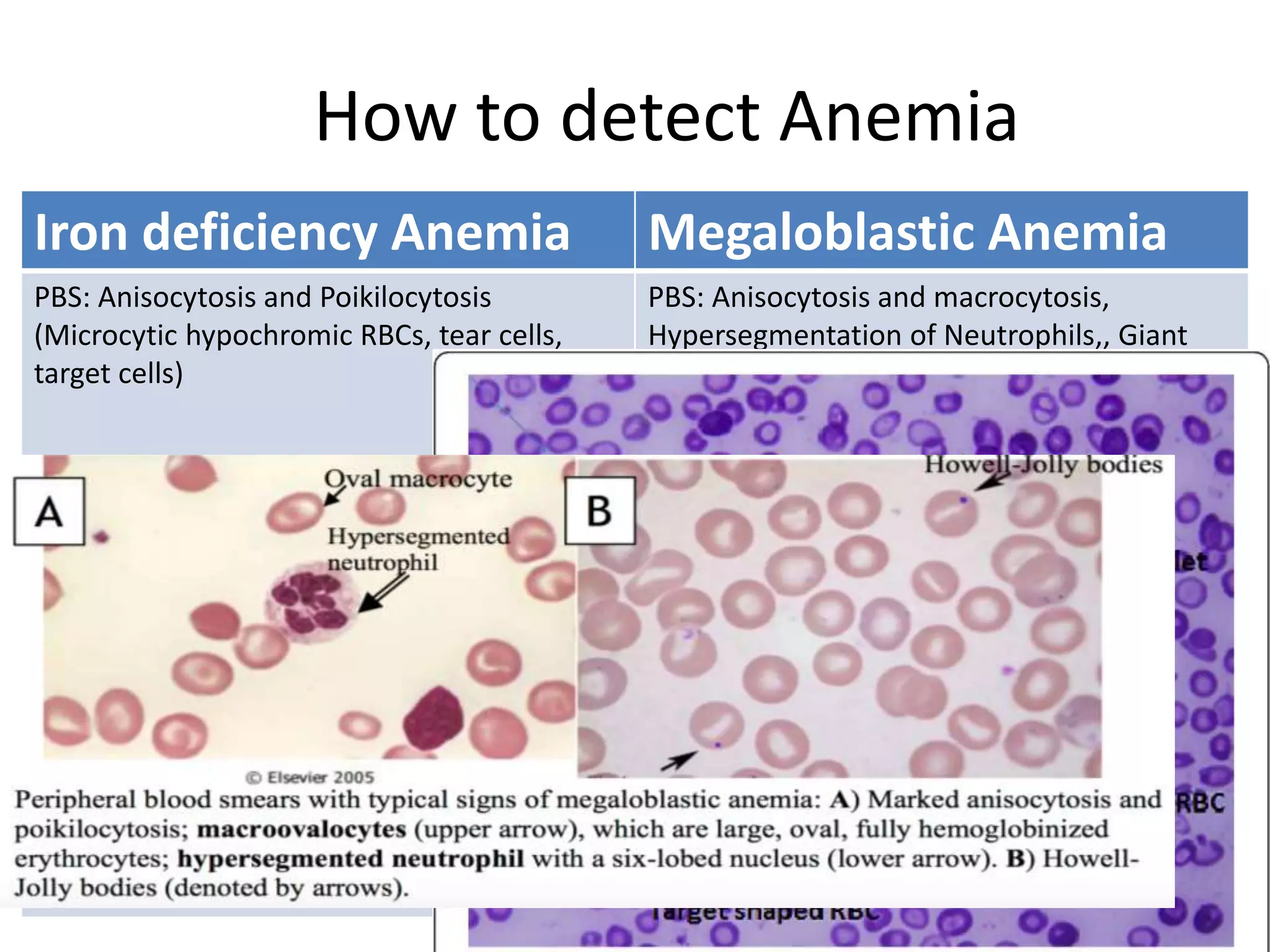 Management of anemia in pregnancy | PPTX