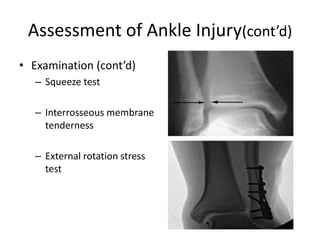 Management of ankle injuries | PPTX
