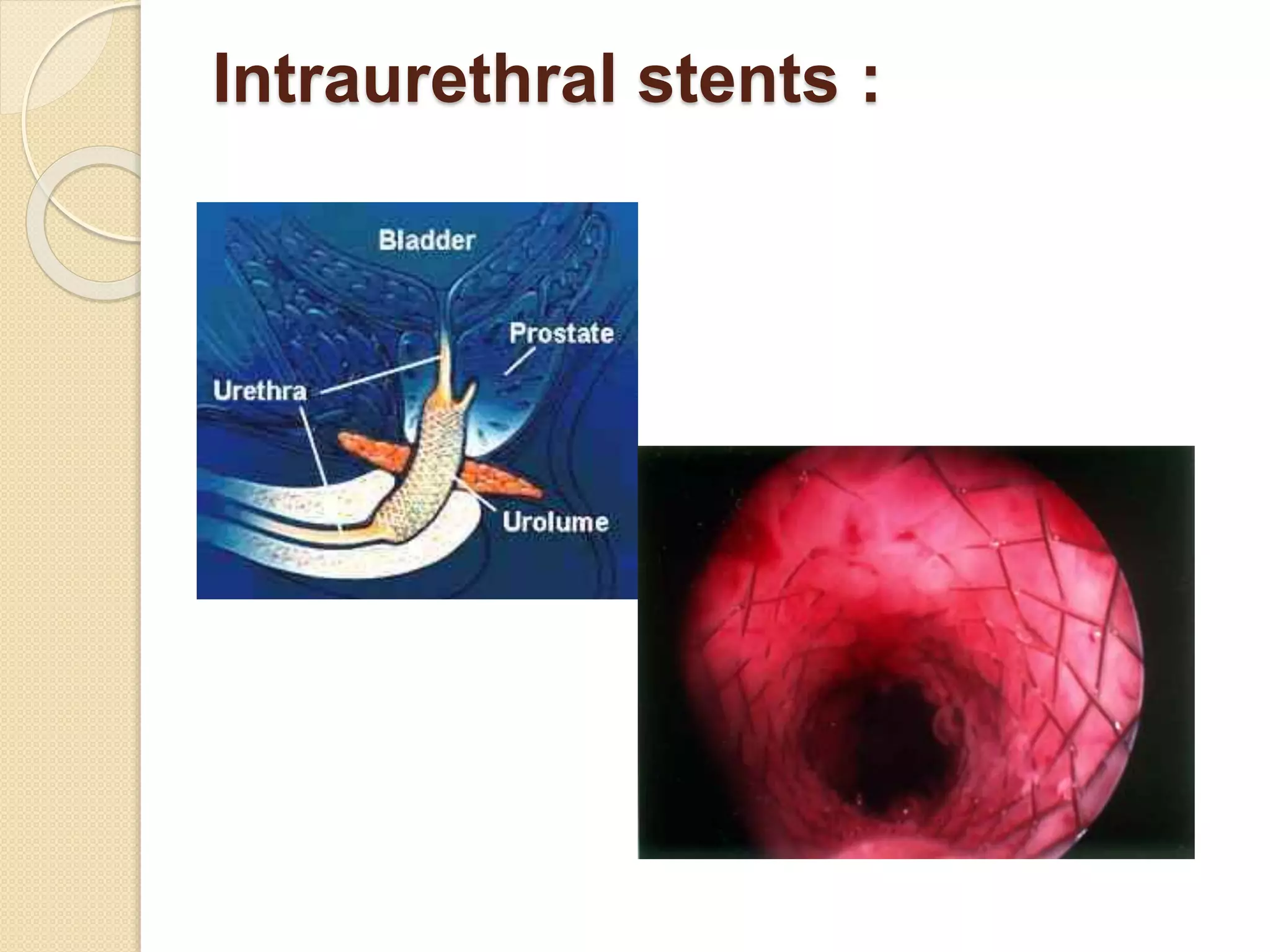 Management of anterior urethral stricture by AUA 2014 | PPTX