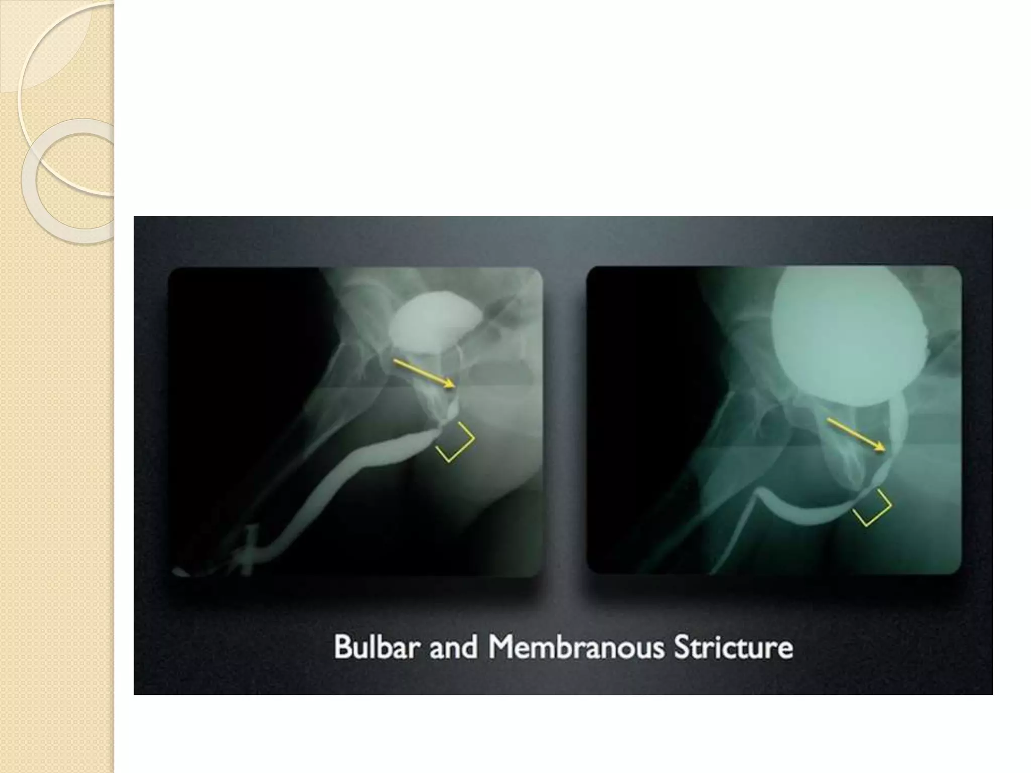 Management of anterior urethral stricture by AUA 2014 | PPTX