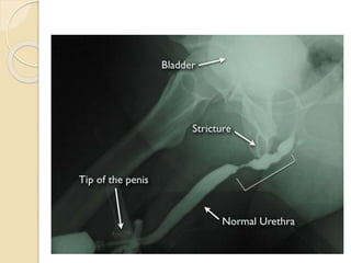 Management of anterior urethral stricture by AUA 2014 | PPTX