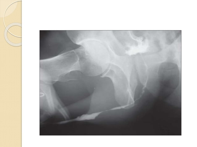 Management of anterior urethral stricture by AUA 2014 | PPT