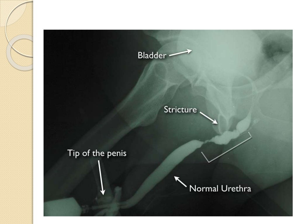 Management of anterior urethral stricture by AUA 2014
