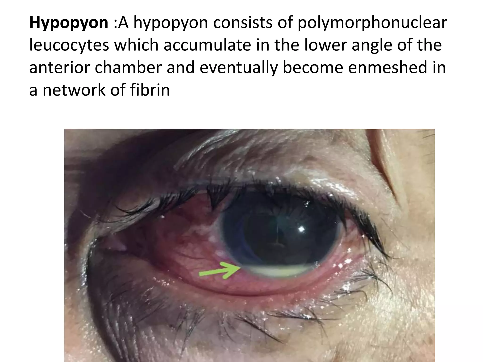 Management of Anterior uveitis.pptx