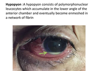 Management of Anterior uveitis.pptx