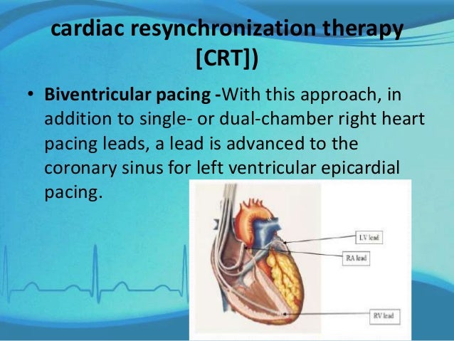 Lv Epicardial Lead | semashow.com