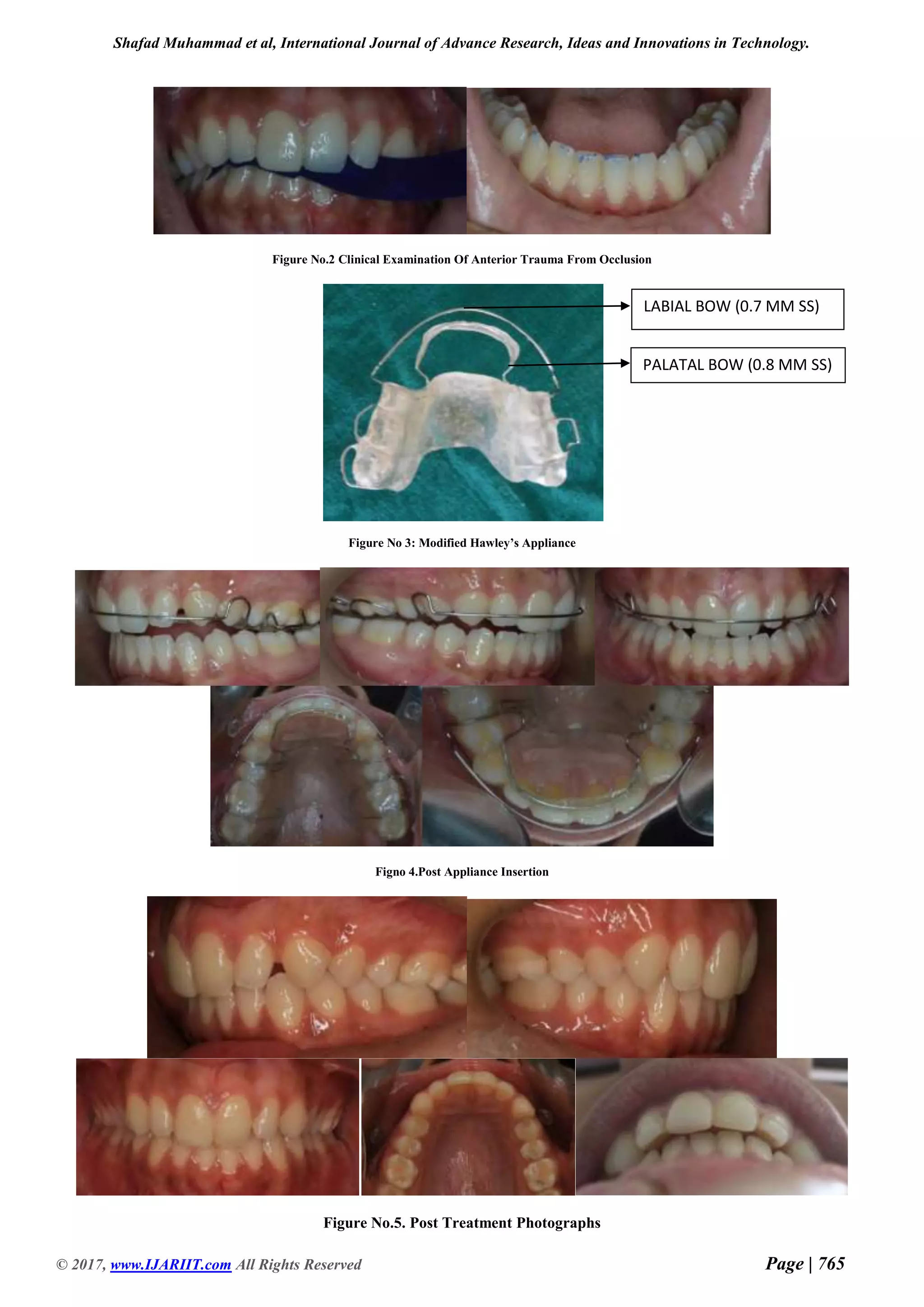 Management of a patient with temporomandibular disorder and trauma from ...