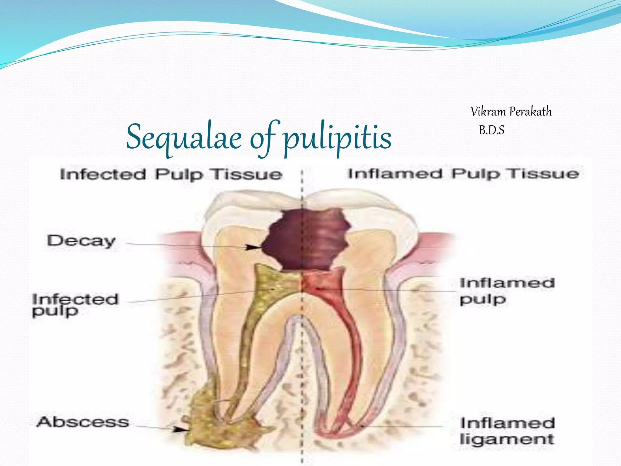 Management of apical lesions | PPTX