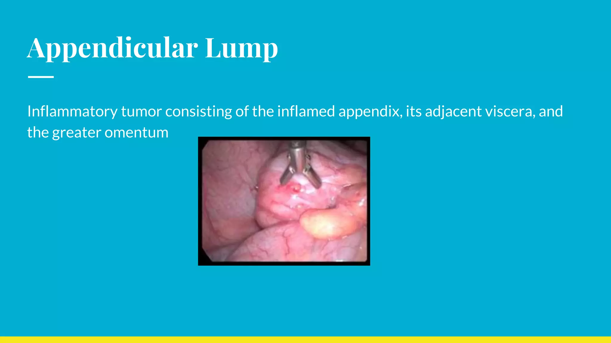 Management of Appendicular Lump | PPTX