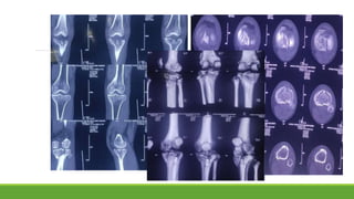Management of articular fracture - case presentation | PPT