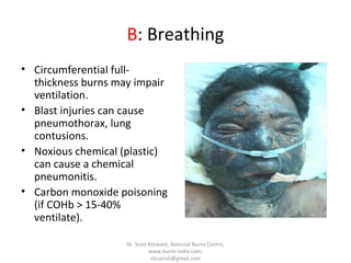 Management of a severely burnt patient by Dr. Sunil Keswani, National ...
