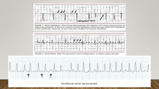MANAGEMENT OF ATRIAL FIBRILLATION.pptx