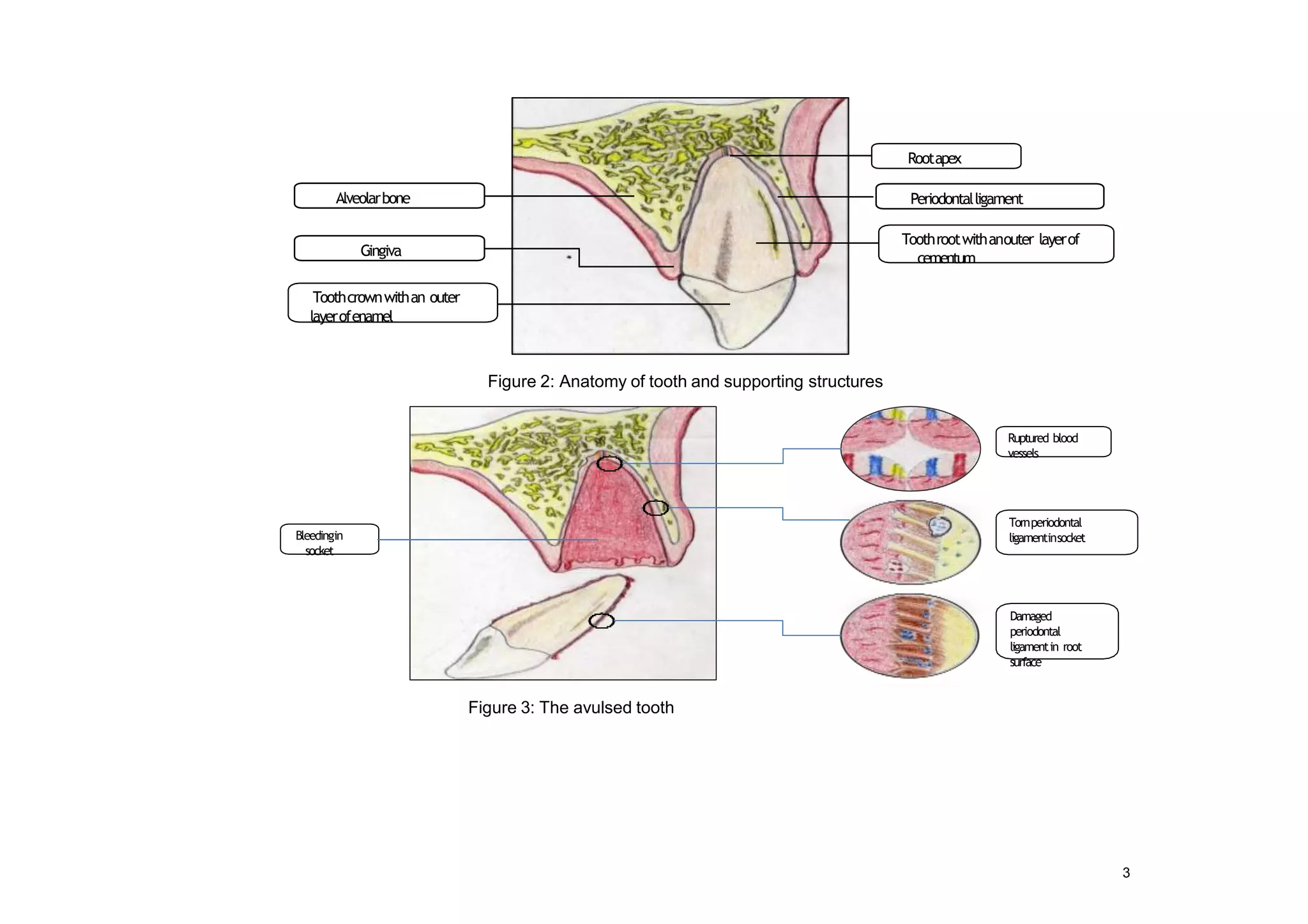 MANAGEMENT OF AVULSED TEETH-converted.pptx