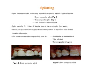MANAGEMENT OF AVULSED TEETH-converted.pptx