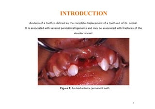 MANAGEMENT OF AVULSED TEETH-converted.pptx