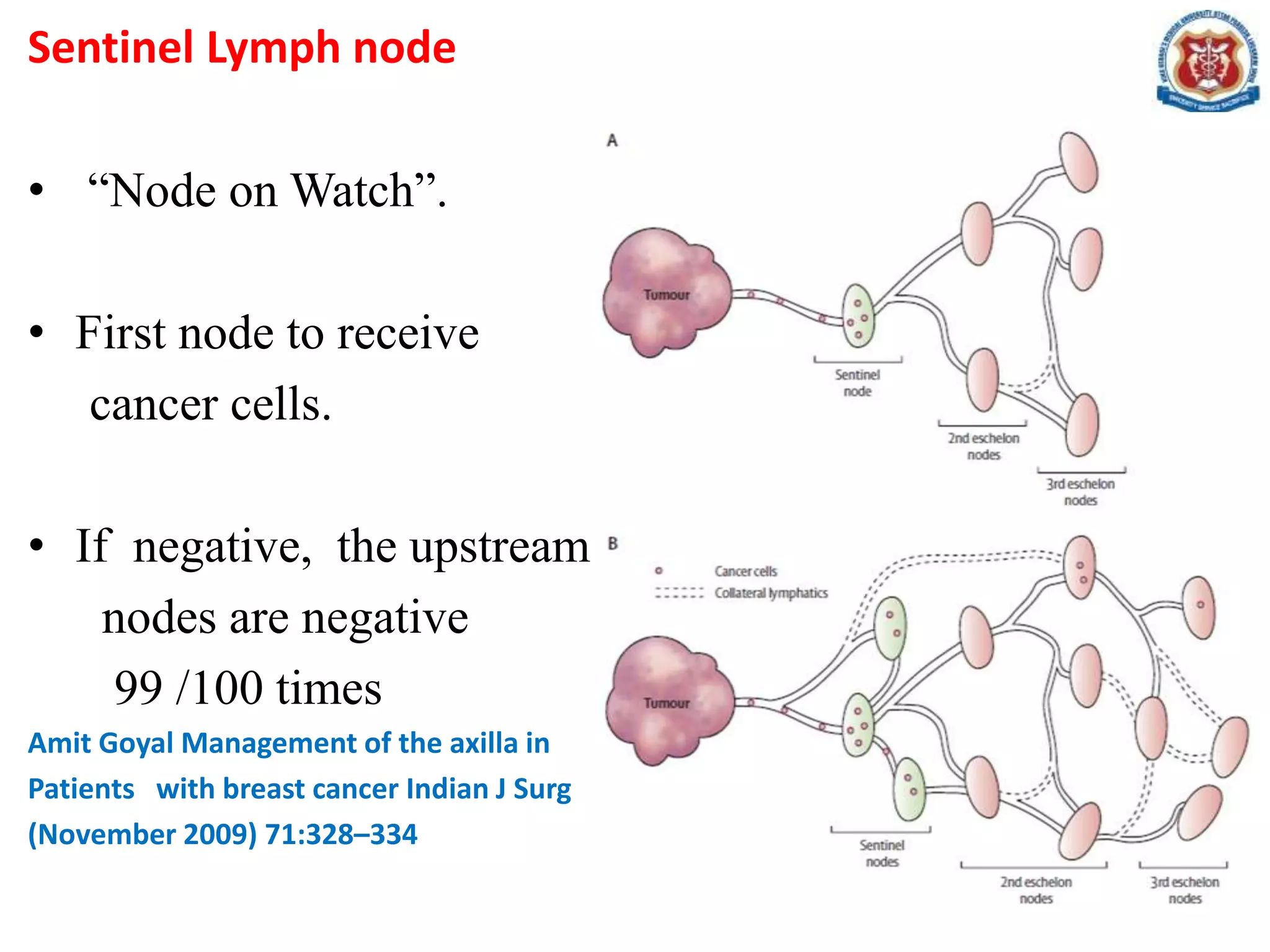 Management of axilla in breast cancer : Recent updates | PPTX