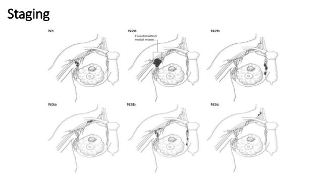 Management of axilla in carcinoma breast