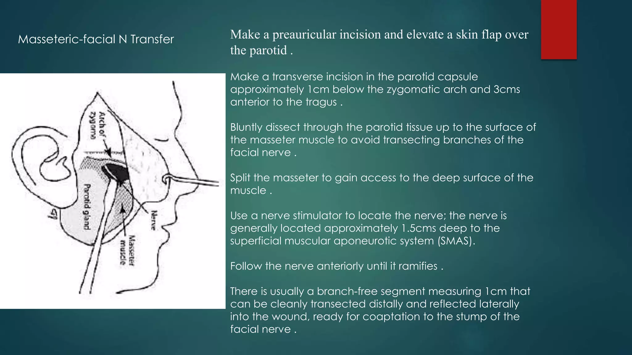 Management of bells palsy | PPTX