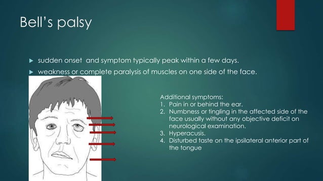 Management of bells palsy | PPT
