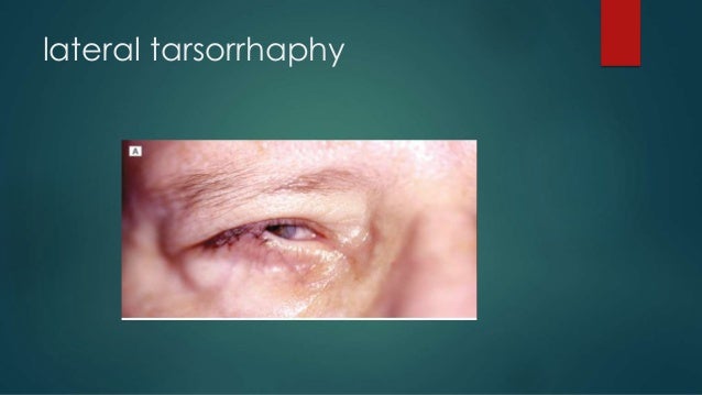 Management Of Bells Palsy