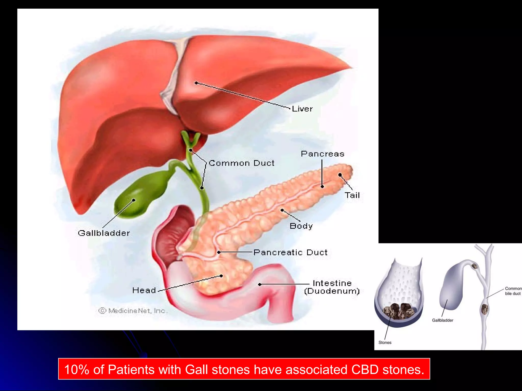 Management of bile duct stones | PPT