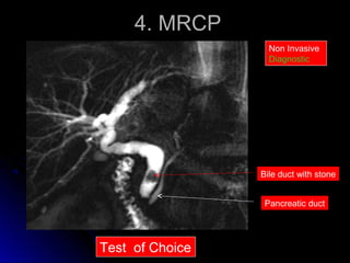 Management of bile duct stones | PPT